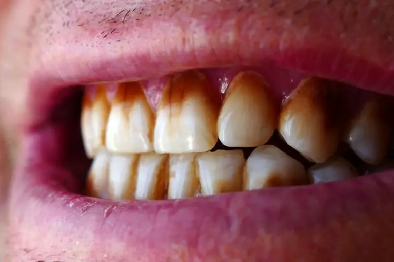 Teeth staining | teeth.org.au
