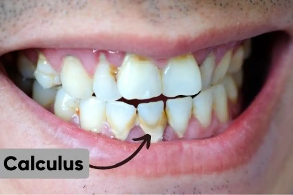 3 Ways Whitening Toothpaste Work | teeth.org.au