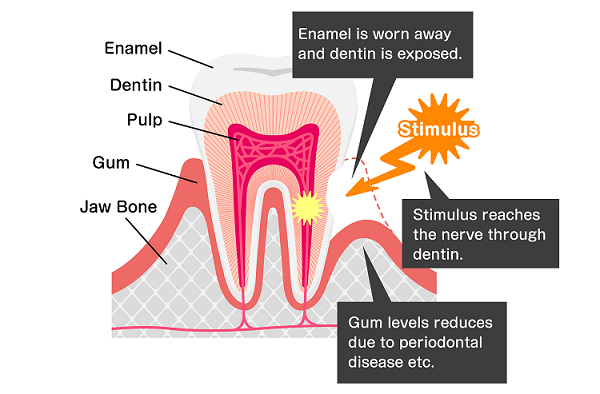 Sensitive Teeth | teeth.org.au