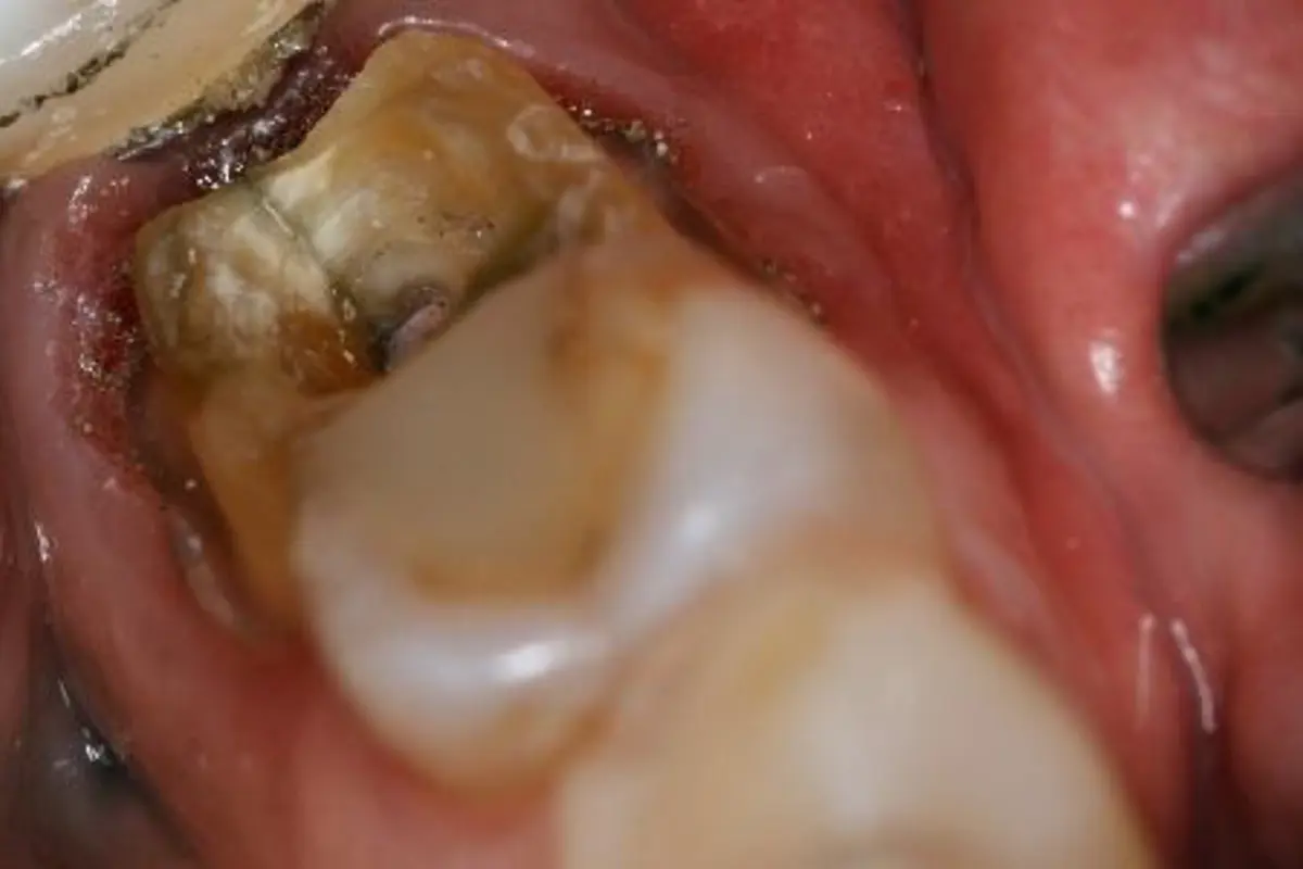 Cracked Teeth | teeth.org.au